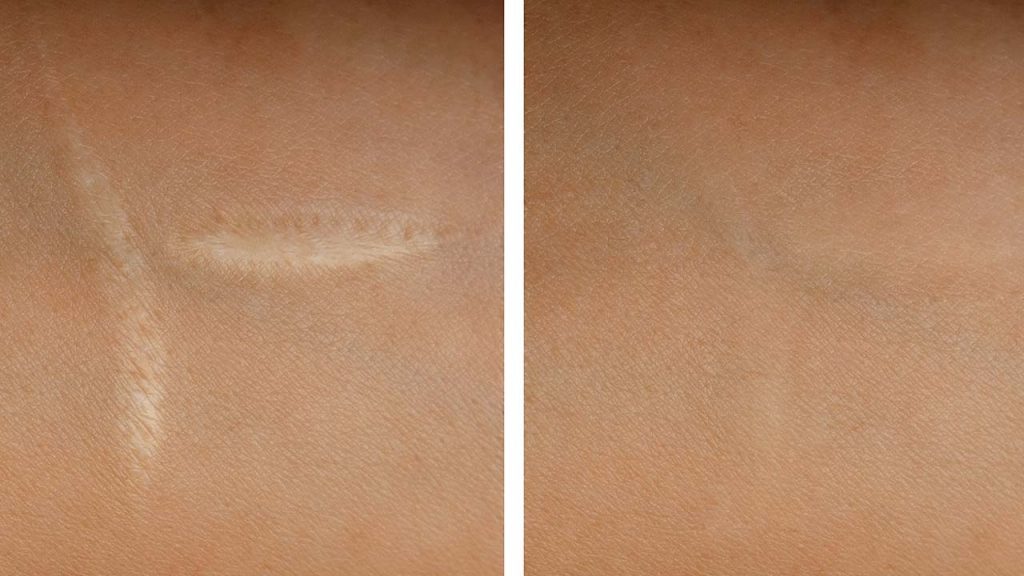 Narben Pigmentation Recklinghausen