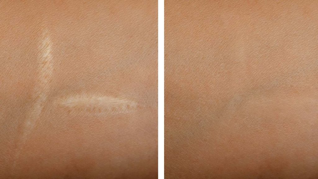 Narben Pigmentation Hagen